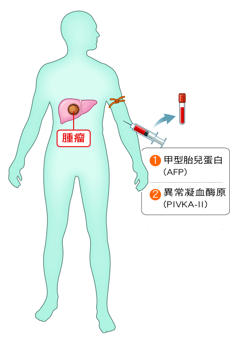 術後第一年復發率約 20 % ！ 肝癌治療後， 減少復發率可以怎麼做？ - Heho健康
